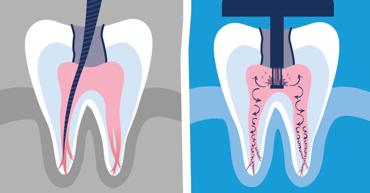 Standard Root Canal Treatment vs. the GentleWave Procedure | GentleWave Procedure